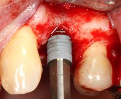 Dental implant placement into fresh extraction sockets – Thoughts on ...